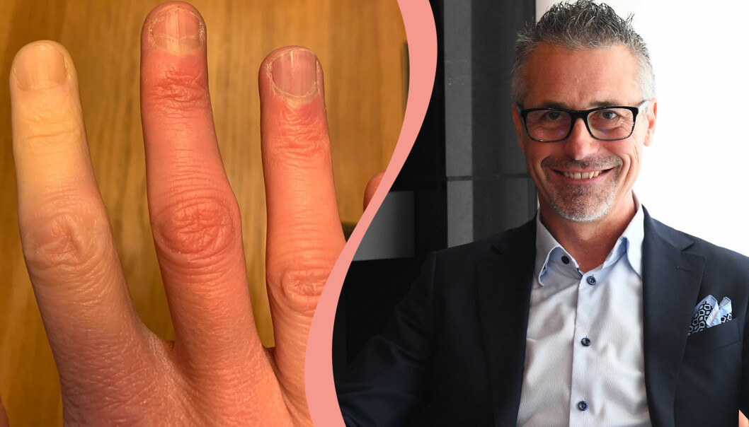 Systemisk skleros: Här är viktiga varningstecknet | Allas